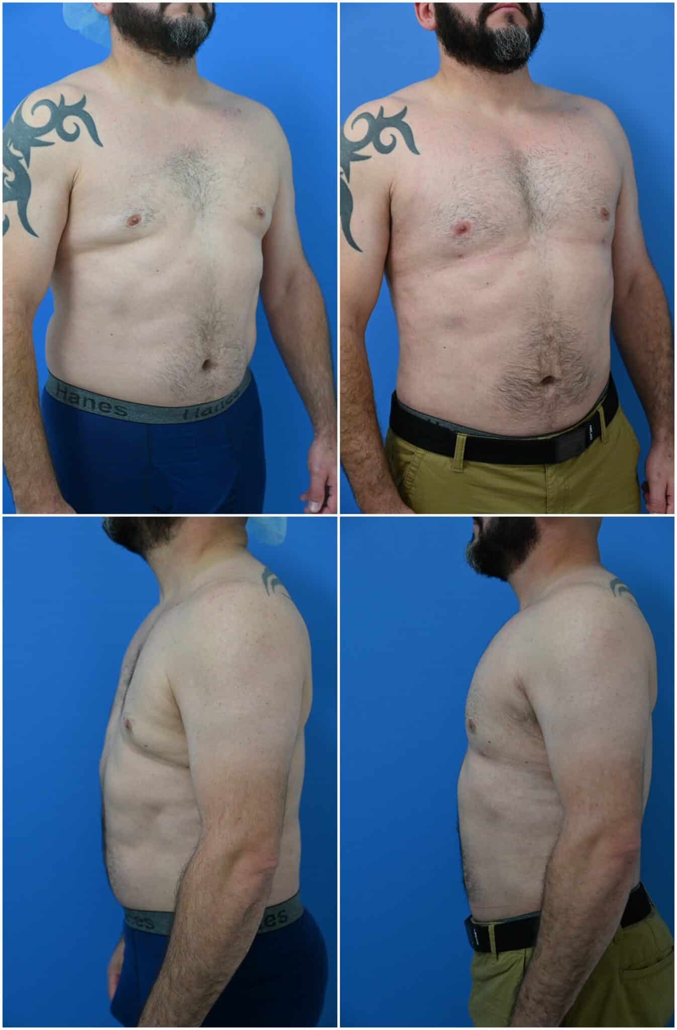 Male Pectoral Implants - Dr. G Cosmetic Surgery