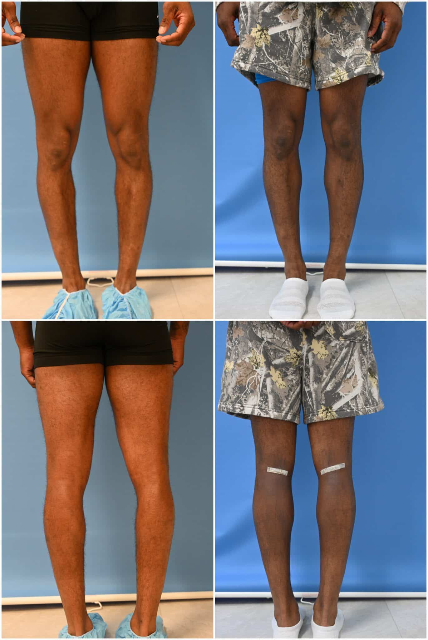 Calf Implants - Dr. G Cosmetic Surgery