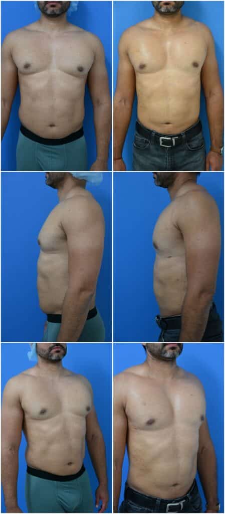 Male Pectoral Implants - Dr. G Cosmetic Surgery